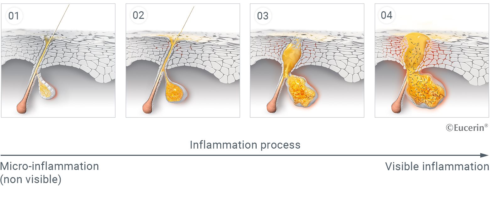 Blemish- prone skin in general | acne | Eucerin